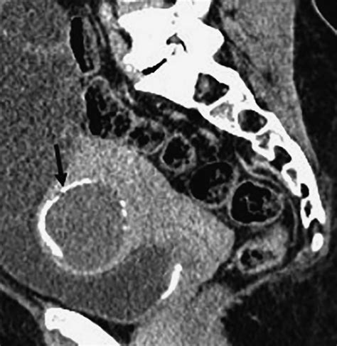 Sagittal Reconstruction Of Contrast Enhanced Computed Tomography Cect
