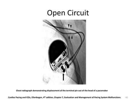 Evaluation And Management Of Pacemaker Malfunction Pptx Heart And Cardiovascular Diseases