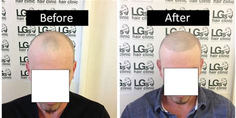 Pin On Scalp Pigmentation By Lgs Hair Clinic