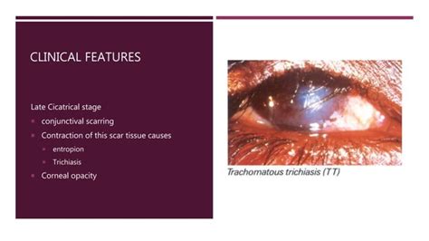 Chlamydia And Eye Ppt Free Download