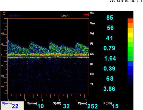 Figure 1 From Effects Of Microbubbles On Transcranial Doppler Ultrasound Assisted Intracranial
