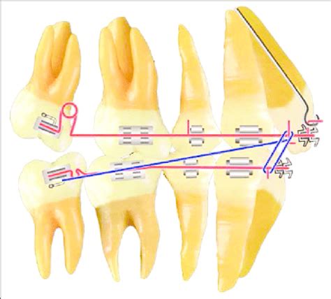 class ii force system denture correction the helical bulbous loop