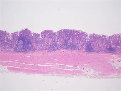 結節状 meddic