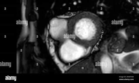 Mri Heart Or Cardiac Mri Magnetic Resonance Imaging Of Heart In