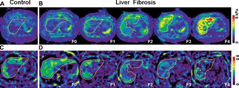 Three Dimensional Mr Elastography Depicts Liver Inflammation Fibrosis