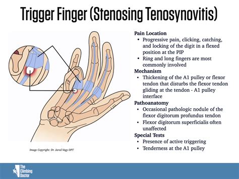 Trigger Finger Definition Etiology Symptoms Diagnosis