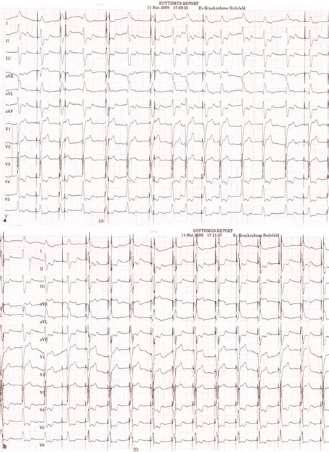 Schrittmacher Ekg Quiz 19 Av Sequenzielle Stimulation Was Passiert