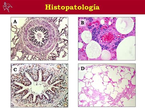 Histopatología A Hiperplasia De La Musculatura Lisa Bronquial En Un