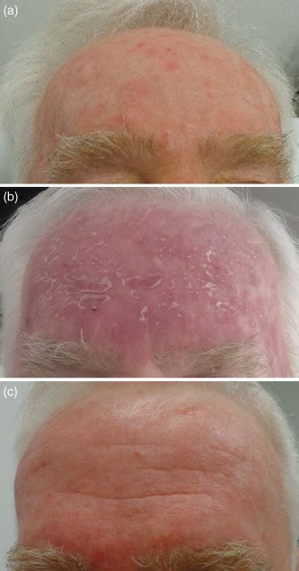 Photographs Of A Patient With Actinic Keratoses A Before Treatment