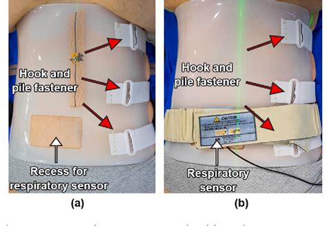 Figure 1 From Reduction Of Intrafraction Pancreas Motion Using An Abdominal Corset Compatible