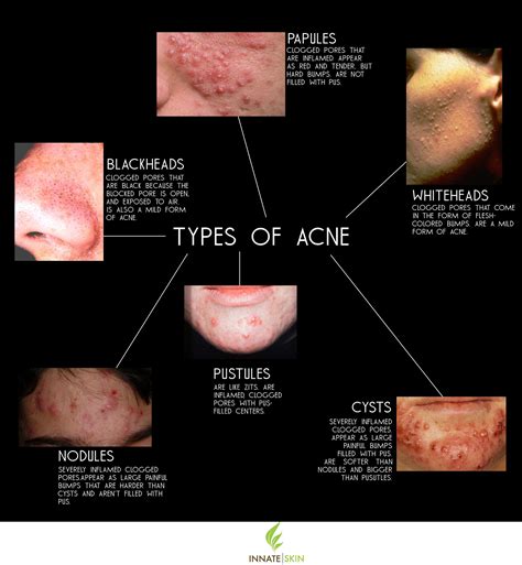 How To Recognize What Kind Of Acne You Have Innate Skin