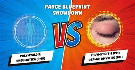 Pance Blueprint Comparisons You Need To Know Polymyalgia Rheumatica Pmr Vs Polymyositis Pm