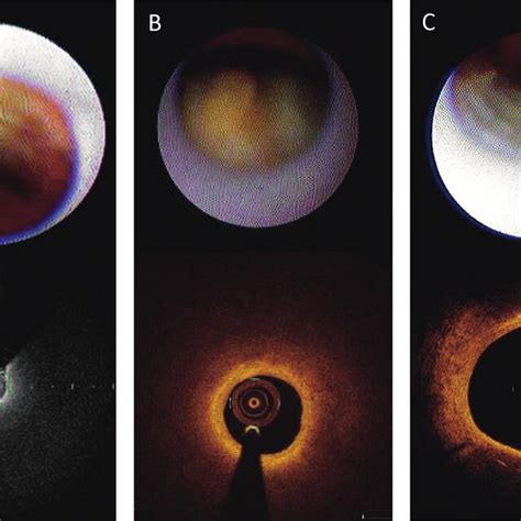 Yellow Neointima By Angioscopy And Corresponding Oct Images A A Download Scientific Diagram
