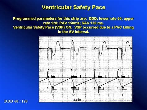 Pacemaker Timing And Intervals Objectives L L L