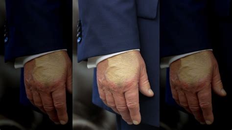 Gnarly Photos Of Trumps Bruised Hand Are A Dark Reminder Of His Age