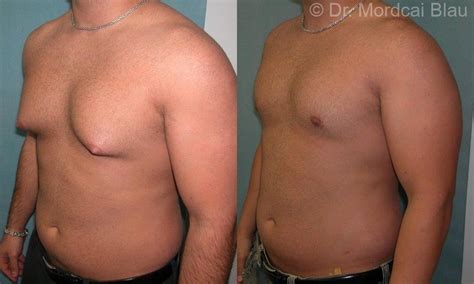 Puffy Nipples Before And After Photos ⋆ Gynecomastia Usa