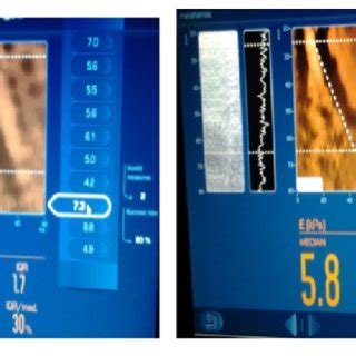 Comparing Fibroscan Results Before During And After Therapy In Group I Download Table