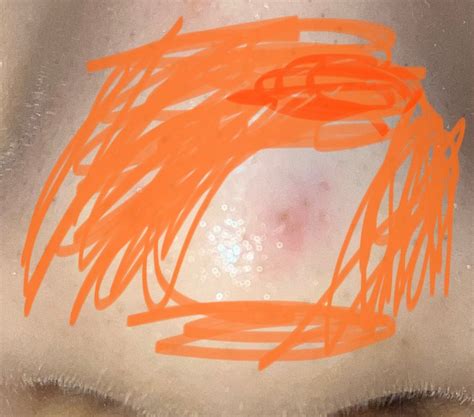 코에 여드름 상처 지식in