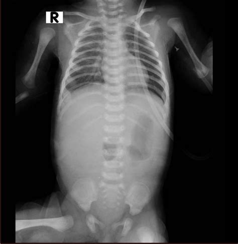 Atresia Duodenum Neoikarsaa