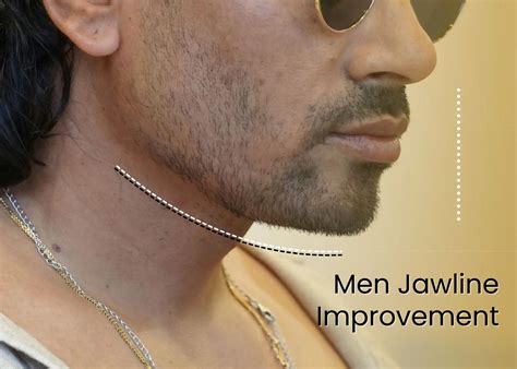 Jawline And Chin Fillers Ogden Utah