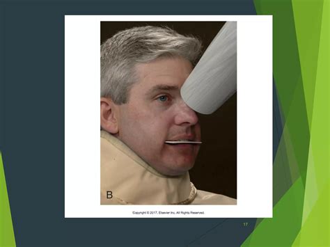 Chapter 21 Occlusal And Localization Technique Ppt