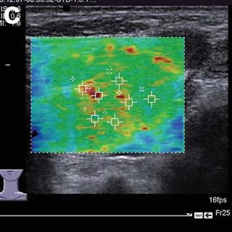 Elastography Can Differentiate Cervical Lymph Nodes Auntminnie