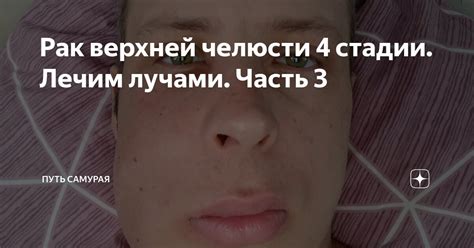 Рак верхней челюсти 4 стадии Лечим лучами Часть 3 Путь самурая Дзен
