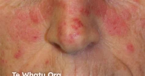Subacute Lupus Erythematosus Image