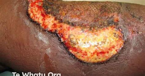 Pyoderma Gangrenosum Image