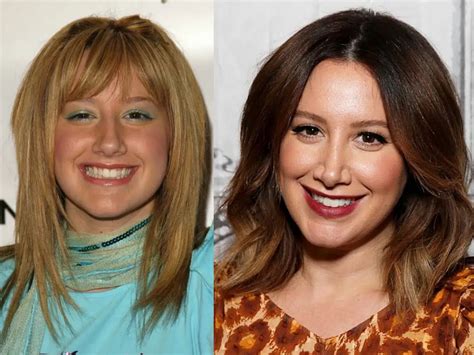 Selena Gomez New Teeth Before After Veneers Braces Lema