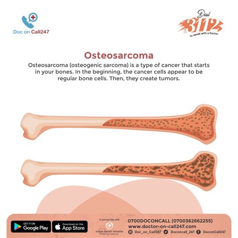 Osteosarcoma