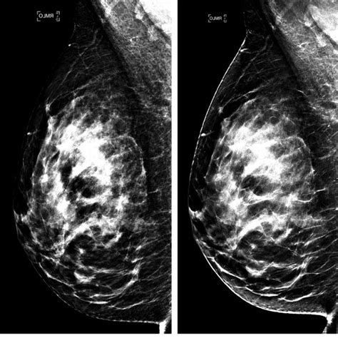 Volpara Density Grade Vdg Versus Bi Rads Density Score From A Breast