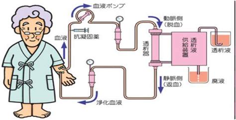 血液透析器是如何制造出来的 艾邦医用高分子网