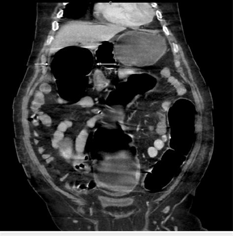 Abdominal Ct In Coronal View Shows Severe Colonic Dilatation White