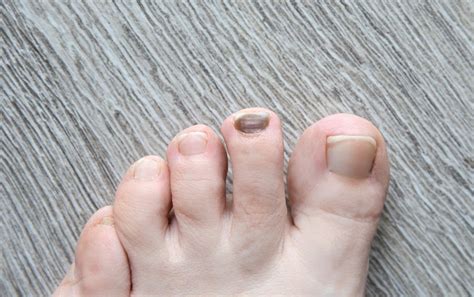Runners Toenail Problems