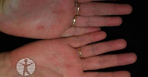 Pustular Psoriasis Of The Hands And Fee Image
