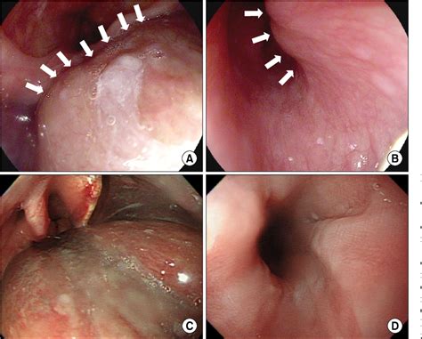 Figure 2 From Early Detection Of Anterior Cervical Osteophytes Causing Dysphagia By