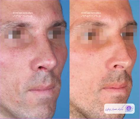 رابطه جنسی بعد از عمل بینی