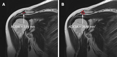 The Acromioclavicular Joint Musculoskeletal Key
