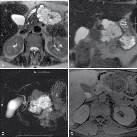 Cystic Pancreatic Lesions Radiology Key