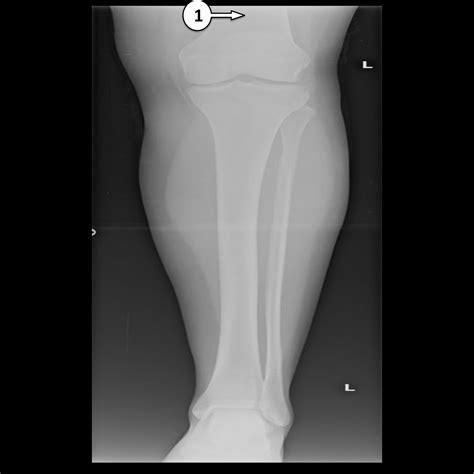 Tibia Fibula X Ray Labeled At Vernon Diemer Blog
