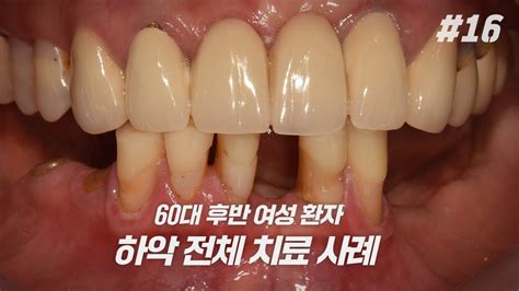60대 환자의 하악 전체 당일 임플란트 치료 사례 Youtube