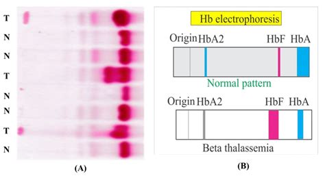 Protein Electrophoresis Diagnosis At Frank Keith Blog