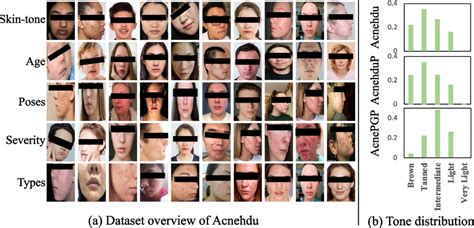 Dataset Overview Both Samples In Acnehdu And Skin Tone Distributions Download Scientific