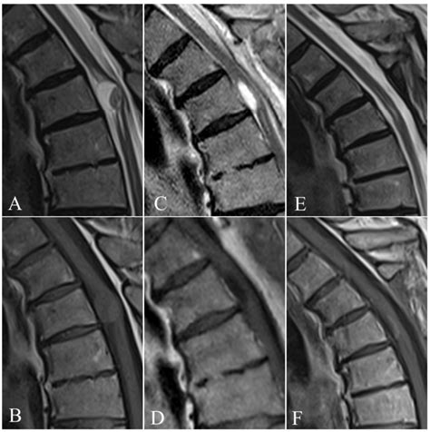 Magnetic Resonance Imaging Mri Showing The Sagittal Scans A