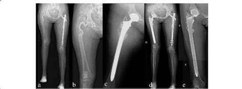 Preoperative Radiography A B Postoperative Radiography C And At