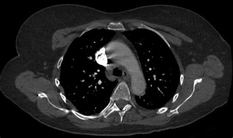 Subsegmental Pulmonary Embolism Should You Treat For How Long