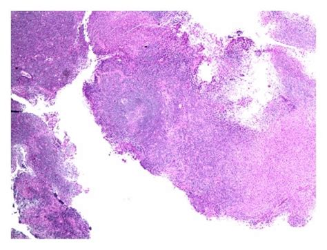 Low Magnification Lymph Node With Focal Well Circumscribed Paracortical Download Scientific