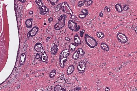 Slowly Enlarging Nodule On The Neck Mdedge