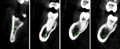 Figure 6 From Deep Segmentation Of The Mandibular Canal A New 3d